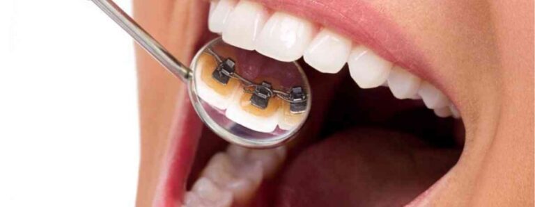 Brackets Linguales que son y Cómo Funcionan